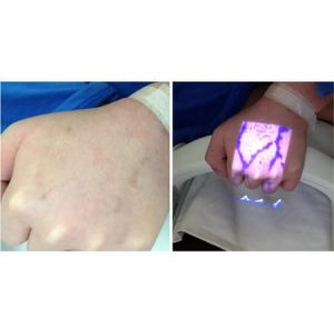 Vein Finder System with stand | Surgical Supplies | Medical Devices NZ